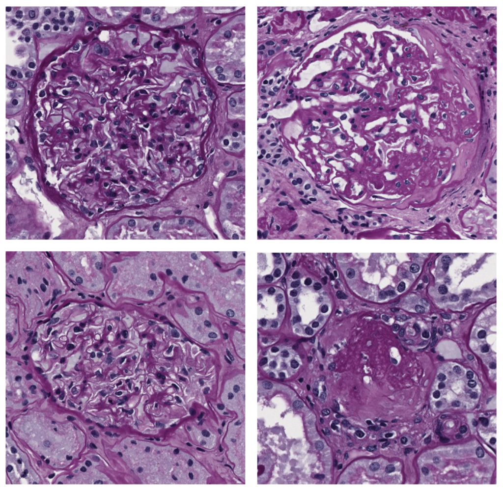 Understanding nephrotic syndrome using deep learning – BOZEK LAB